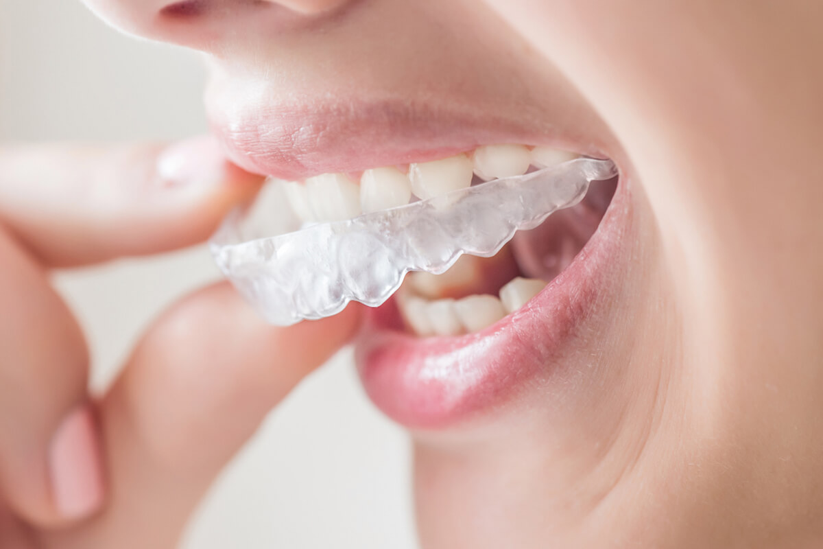 Can Invisalign Fix An Underbite? - San Francisco Dental Wellness
